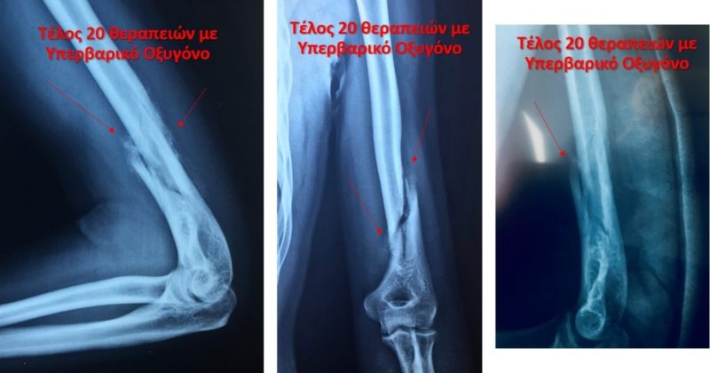 Συντριπτικό Κάταγμα Βραχιονίου Οστού - Υπερβαρική Καταδυτική Ιατρική Αθηνών